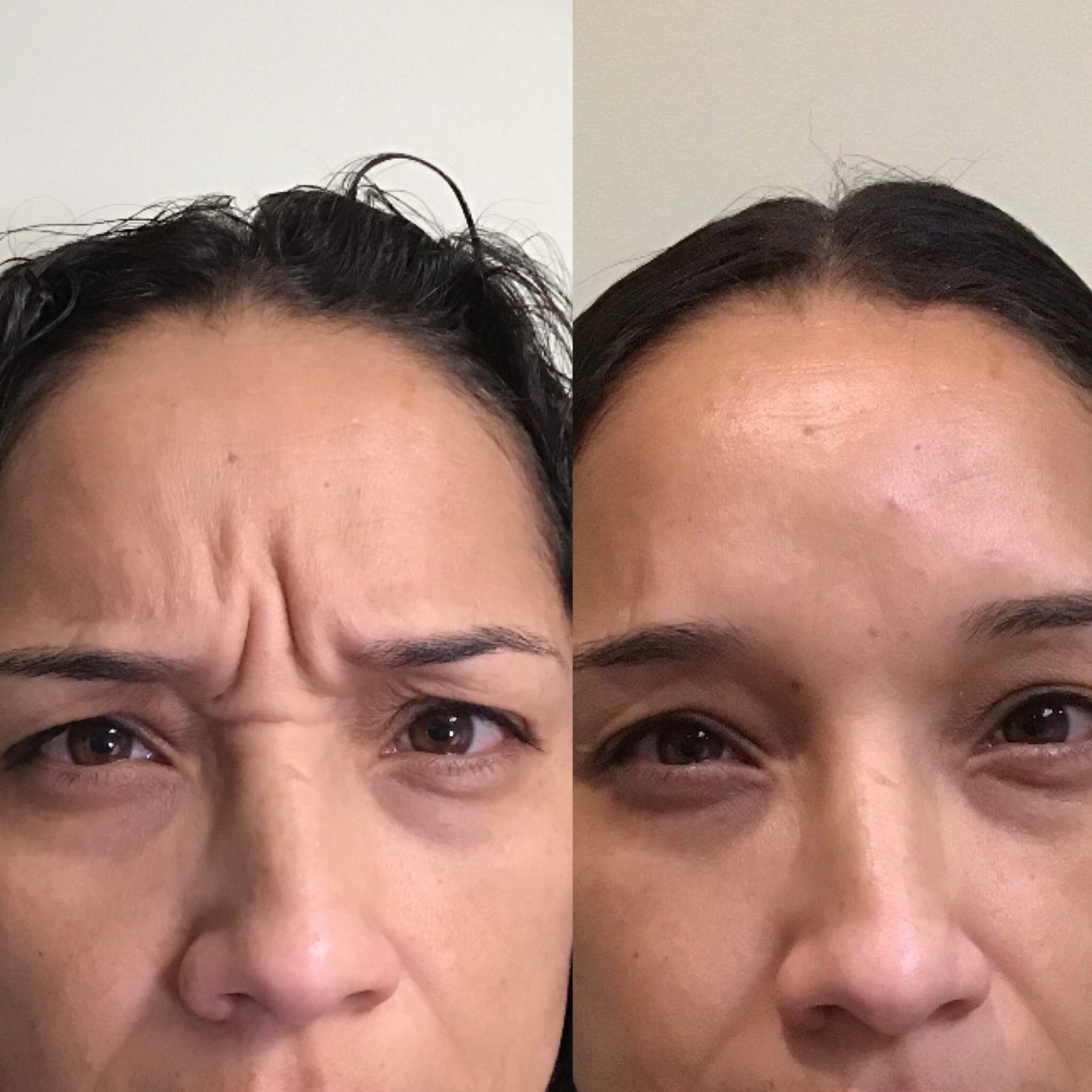 New Jersey Botox® Treatment