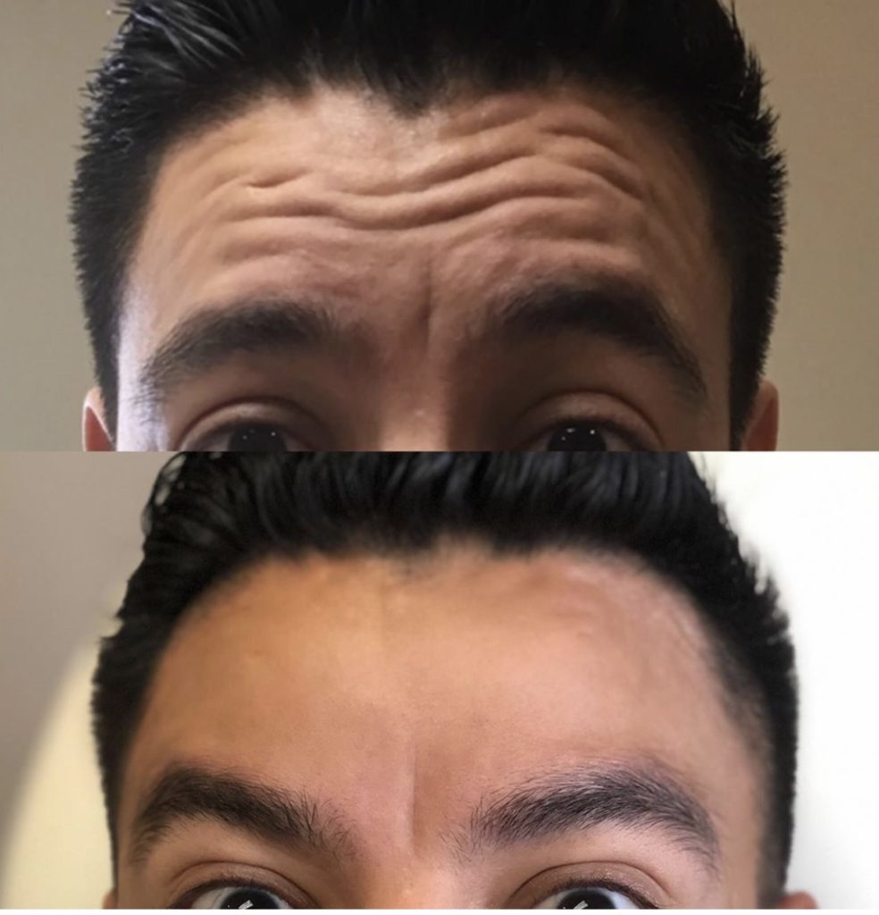 New Jersey Botox® Treatment